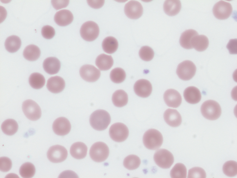 Peripheral smear quiz • The Blood Project
