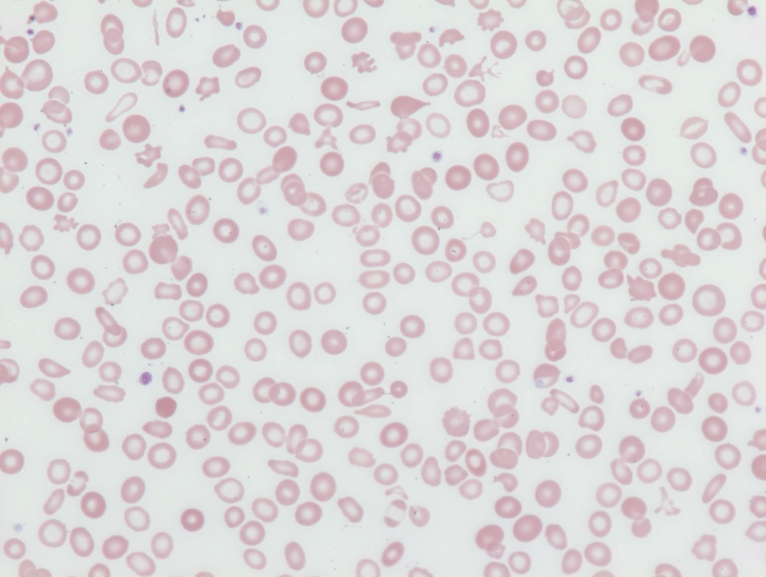 Clue: Elevated zinc protoporphyrin • The Blood Project