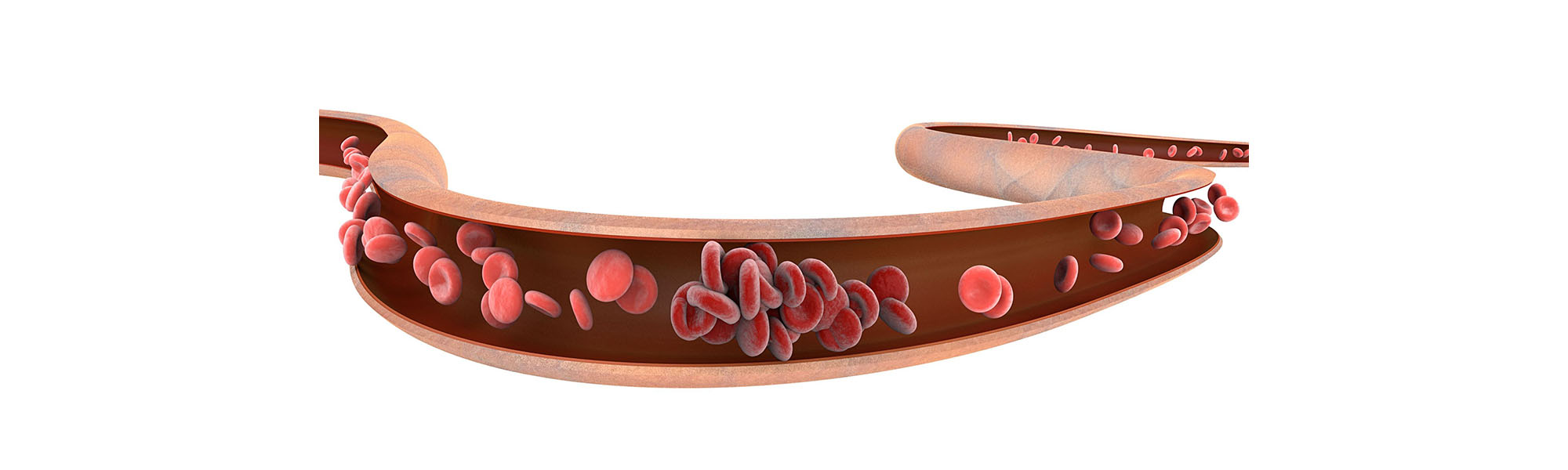 Hereditary TTP: What Hematologists Should Know • The Blood Project