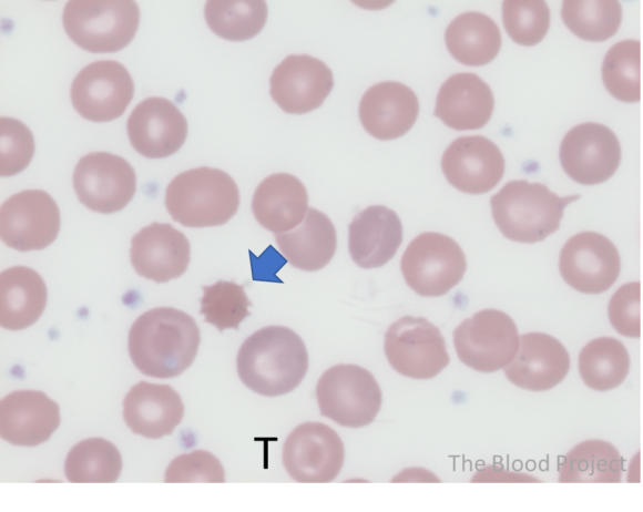 Pyruvate Kinase Deficiency • The Blood Project