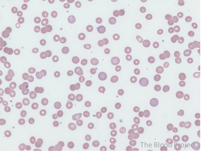 Warm Autoimmune Hemolytic Anemia • The Blood Project