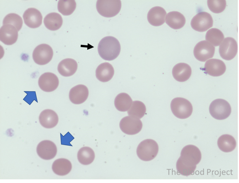 Warm Autoimmune Hemolytic Anemia • The Blood Project