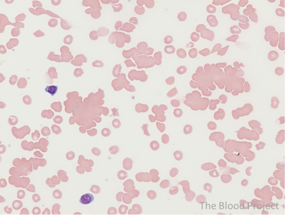 Cold Agglutinin Disease • The Blood Project