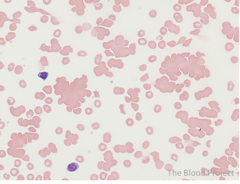 Cold Agglutinin Disease • The Blood Project