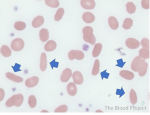 Elliptocytes • The Blood Project