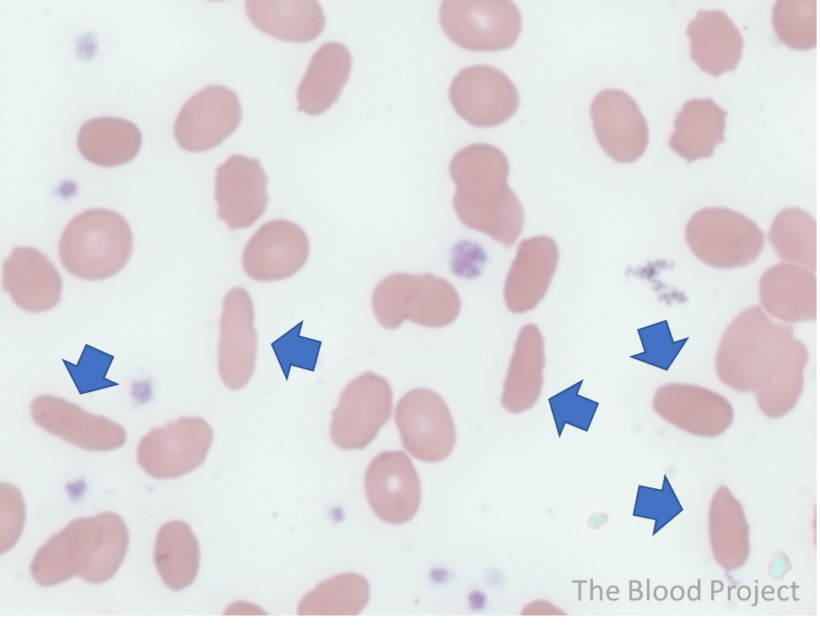 Elliptocytes • The Blood Project