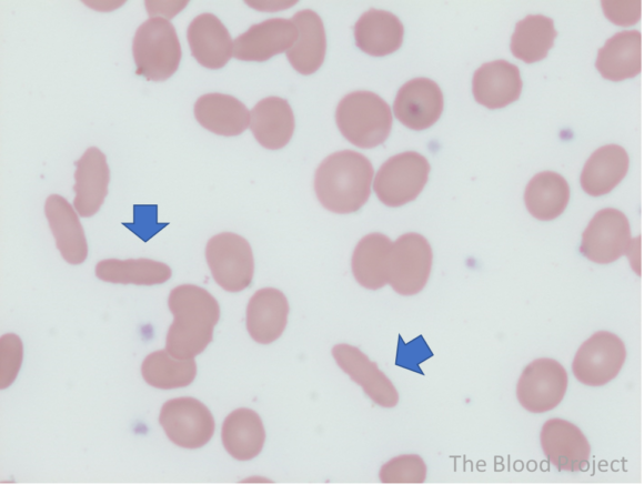 Elliptocytes • The Blood Project