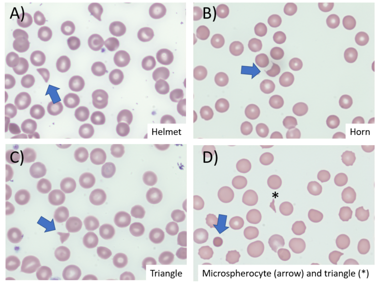 Schistocytes • The Blood Project