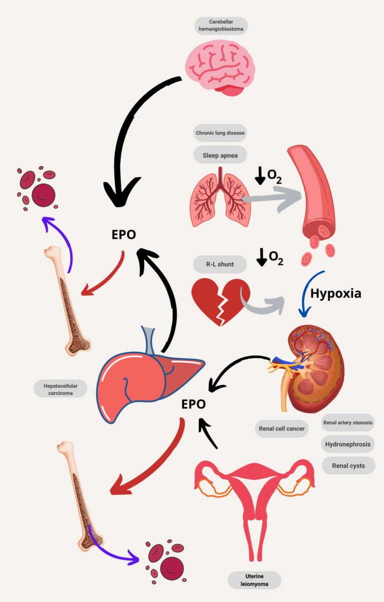 Polycythemia/Erythrocytosis - Differential Diagnosis • The Blood Project