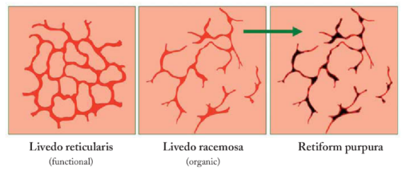 Livedo reticularis • The Blood Project