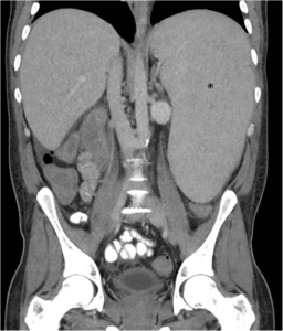 Splenomegaly - Differential Diagnosis • The Blood Project