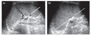 Splenomegaly - Differential Diagnosis • The Blood Project