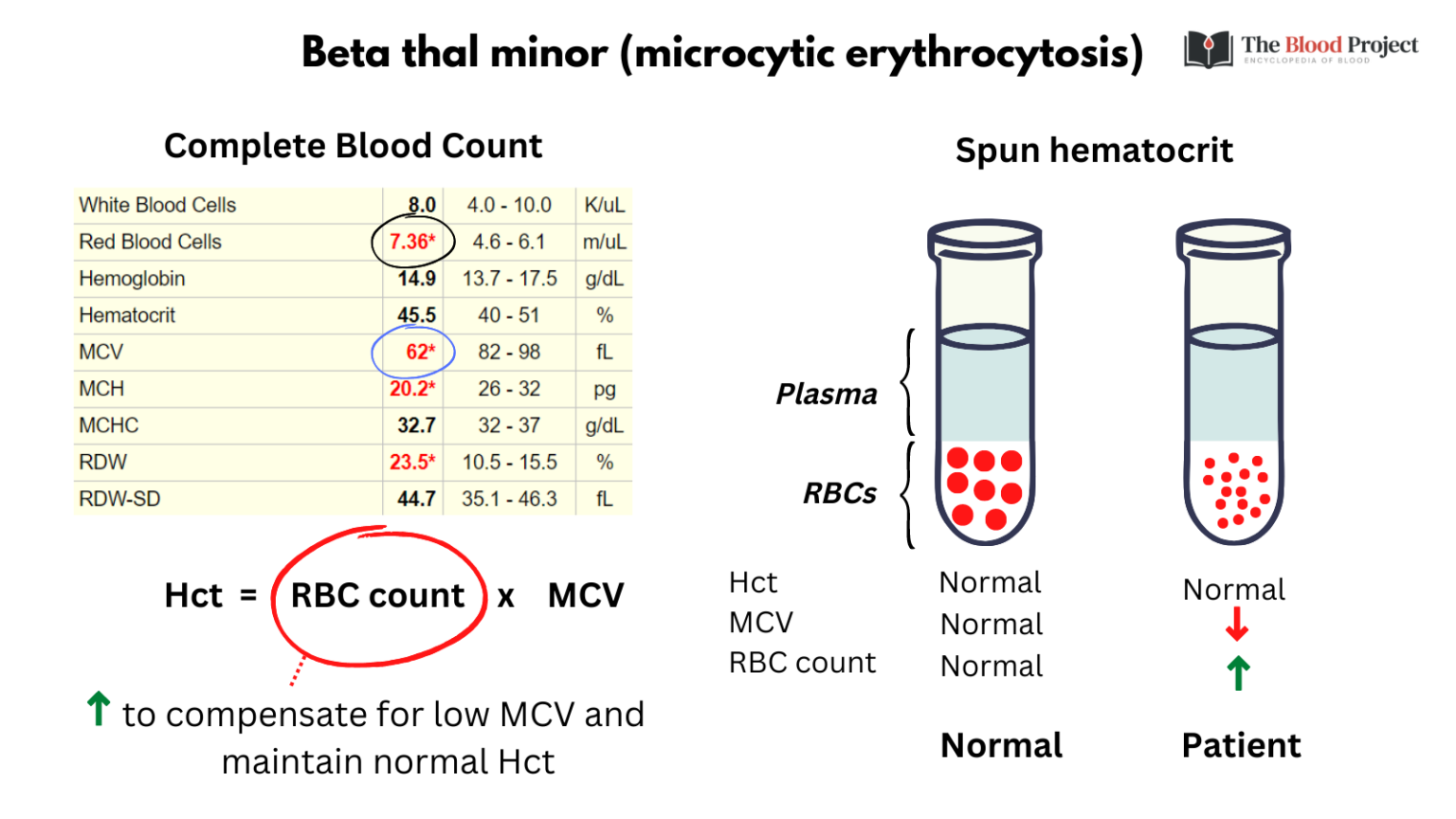 Beta Thal Minor (Microcytic Erythrocytosis) • The Blood Project