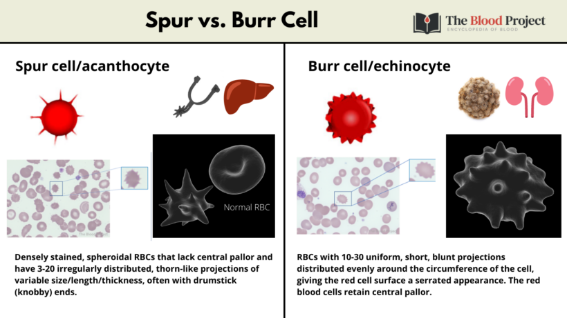 Spur vs. Burr Cell • The Blood Project