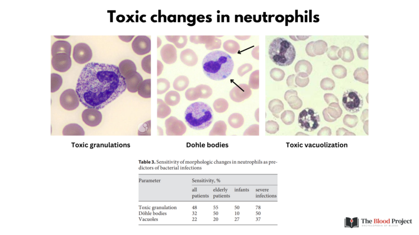 Toxic Changes in Neutrophils • The Blood Project