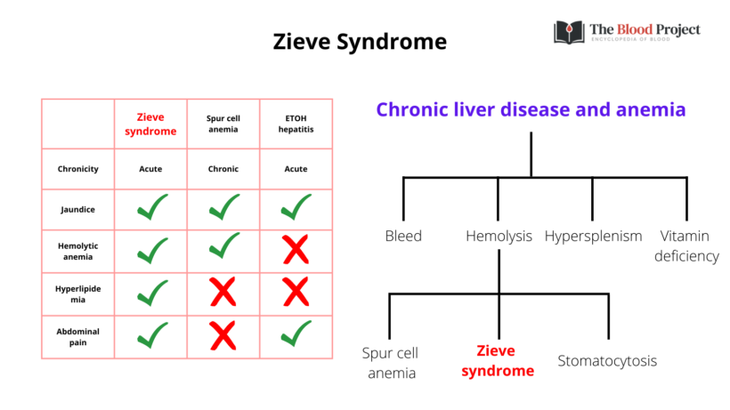 Zieve Syndrome • The Blood Project