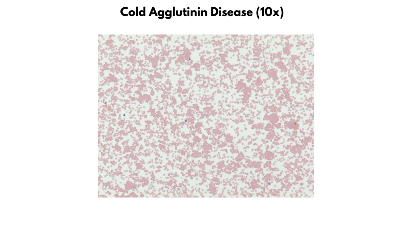 Hemolytic Anemias • The Blood Project