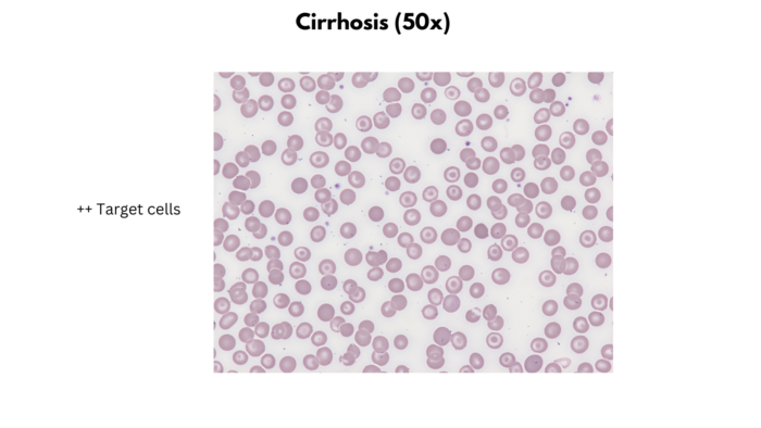 Macrocytic Anemias • The Blood Project