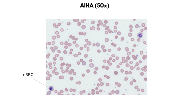Hemolytic Anemias • The Blood Project