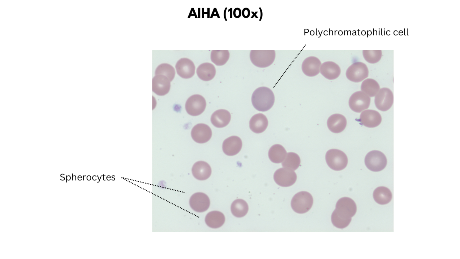 Hemolytic Anemias • The Blood Project