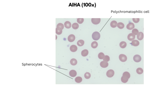 Hemolytic Anemias • The Blood Project