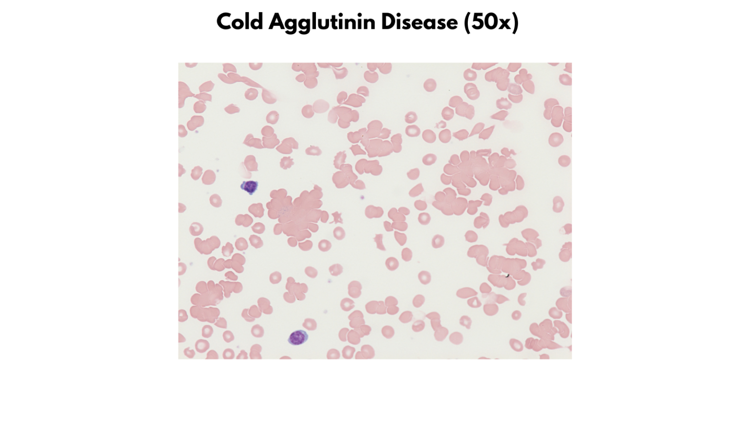 Hemolytic Anemias • The Blood Project