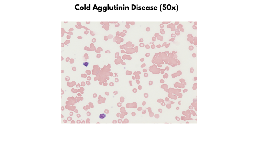 Hemolytic Anemias • The Blood Project