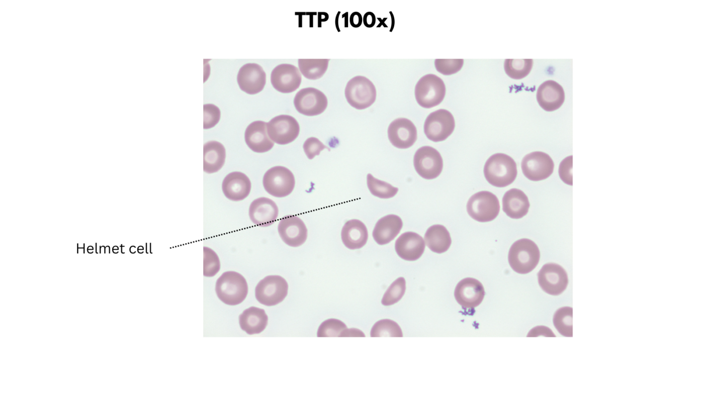 Hemolytic Anemias • The Blood Project