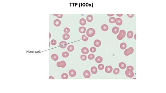Hemolytic Anemias • The Blood Project