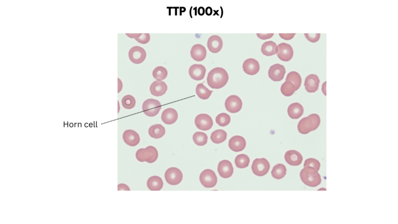 Hemolytic Anemias • The Blood Project