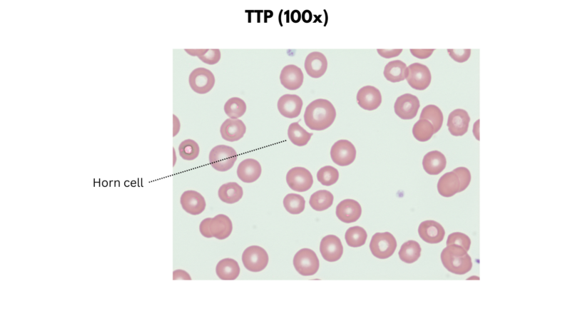 Hemolytic Anemias • The Blood Project