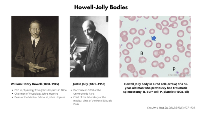 Eponym: Howell-Jolly Body • The Blood Project