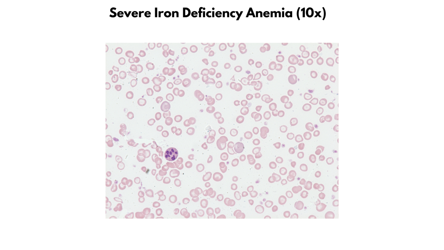 Microcytic Anemias • The Blood Project