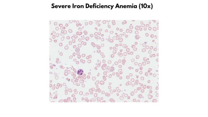 Microcytic Anemias • The Blood Project