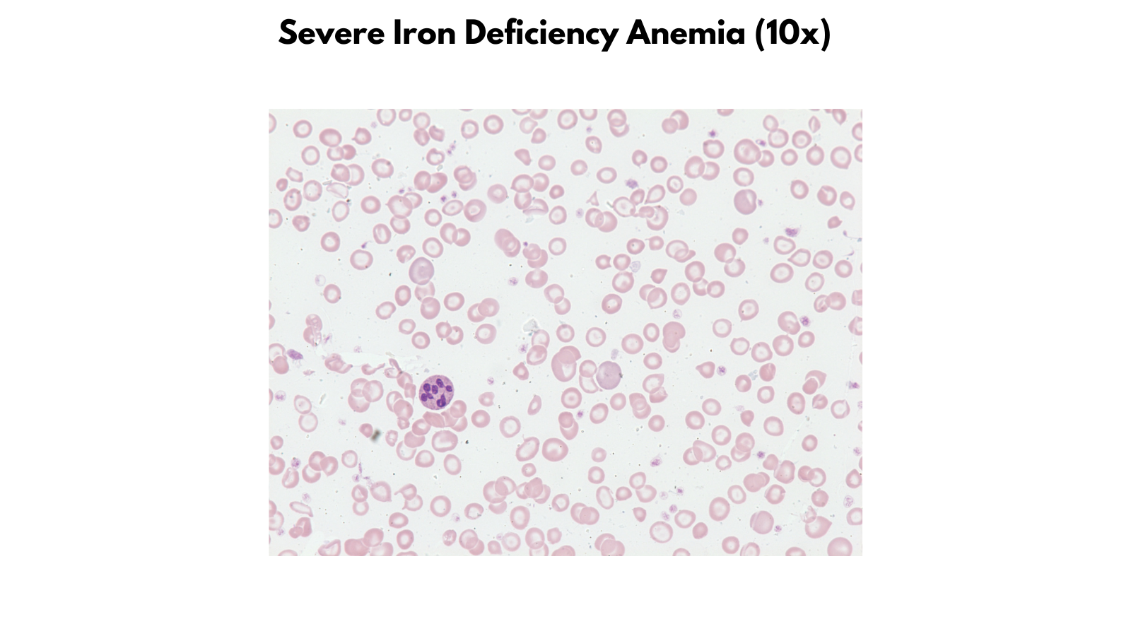Microcytic Anemias • The Blood Project