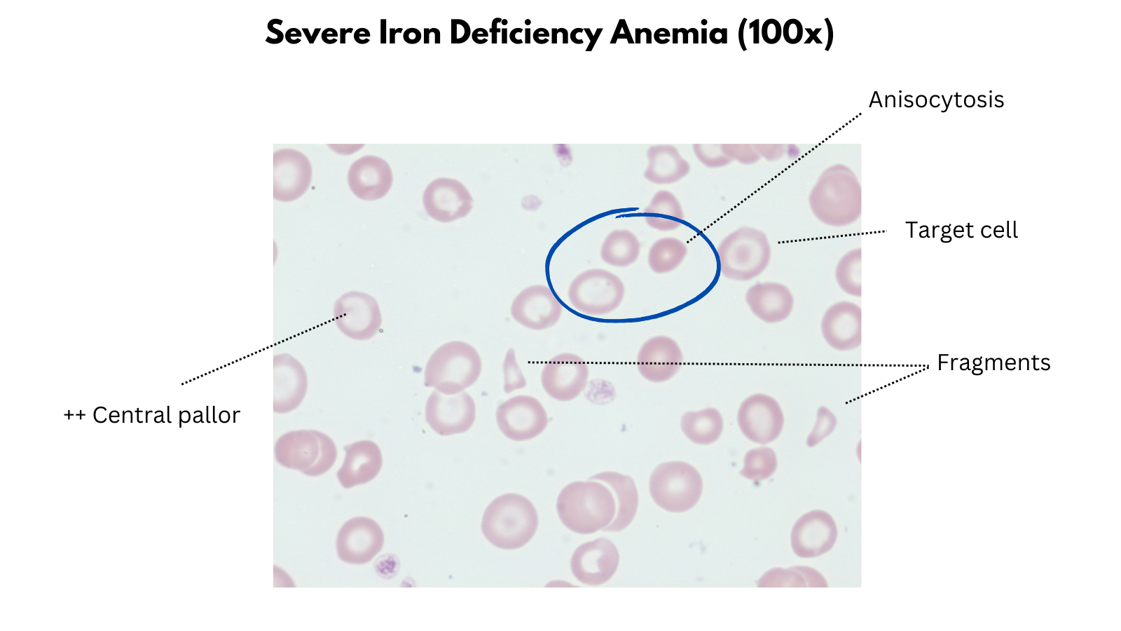 Microcytic Anemias • The Blood Project