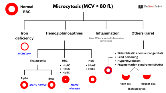 Microcytic Anemias • The Blood Project