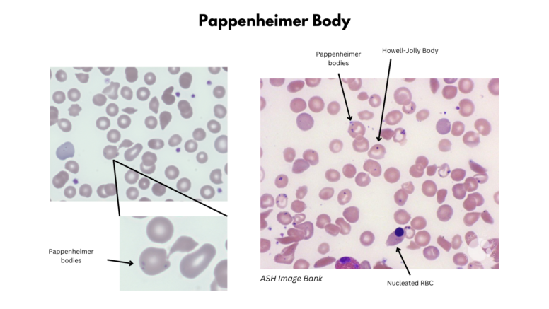 Red Blood Cell Inclusions • The Blood Project