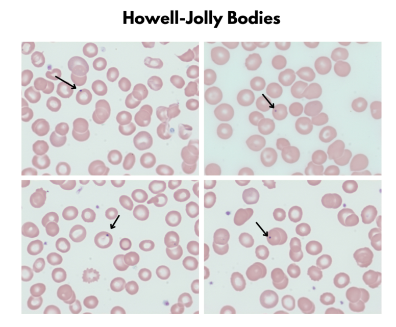 Red Blood Cell Inclusions • The Blood Project