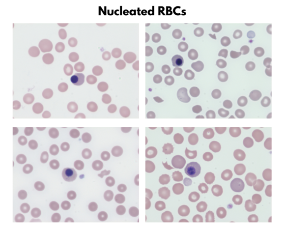 Red Cell Inclusions • The Blood Project