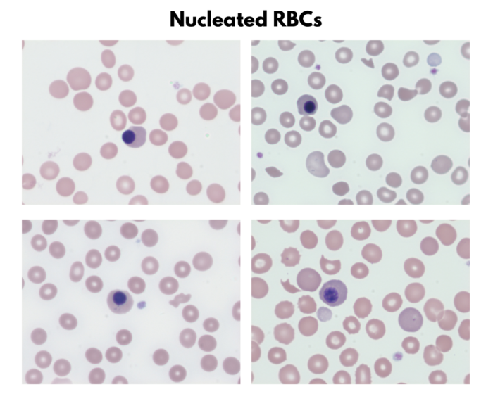 Red Cell Inclusions • The Blood Project