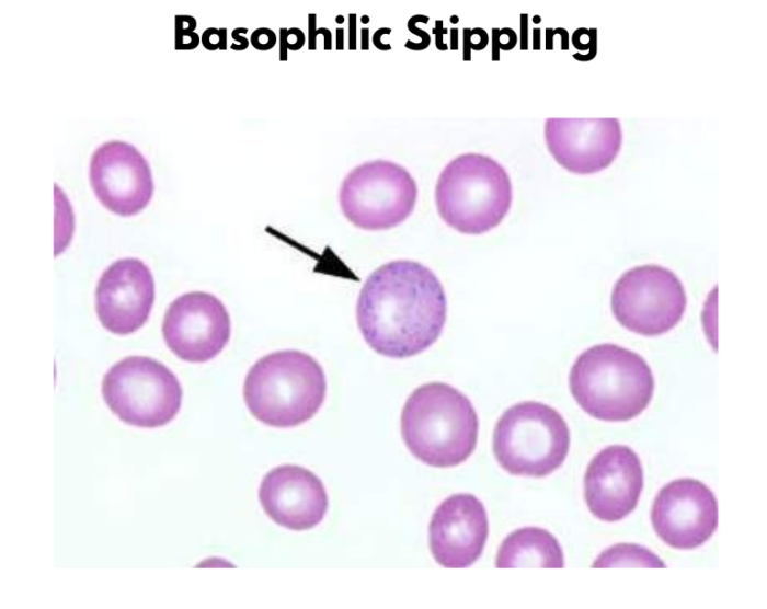 Red Blood Cell Inclusions • The Blood Project