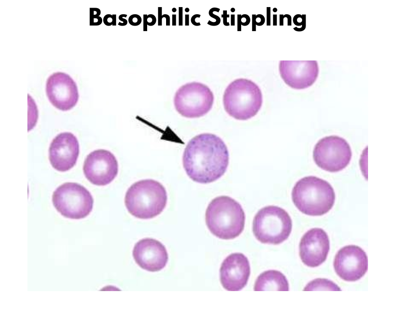 Red Blood Cell Inclusions • The Blood Project