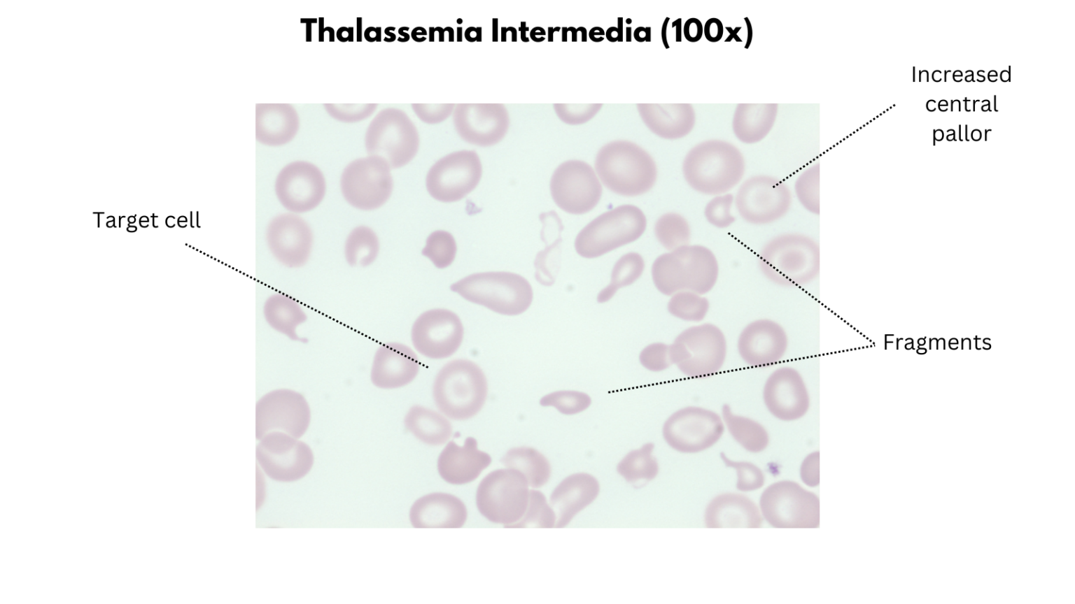 Microcytic Anemias • The Blood Project
