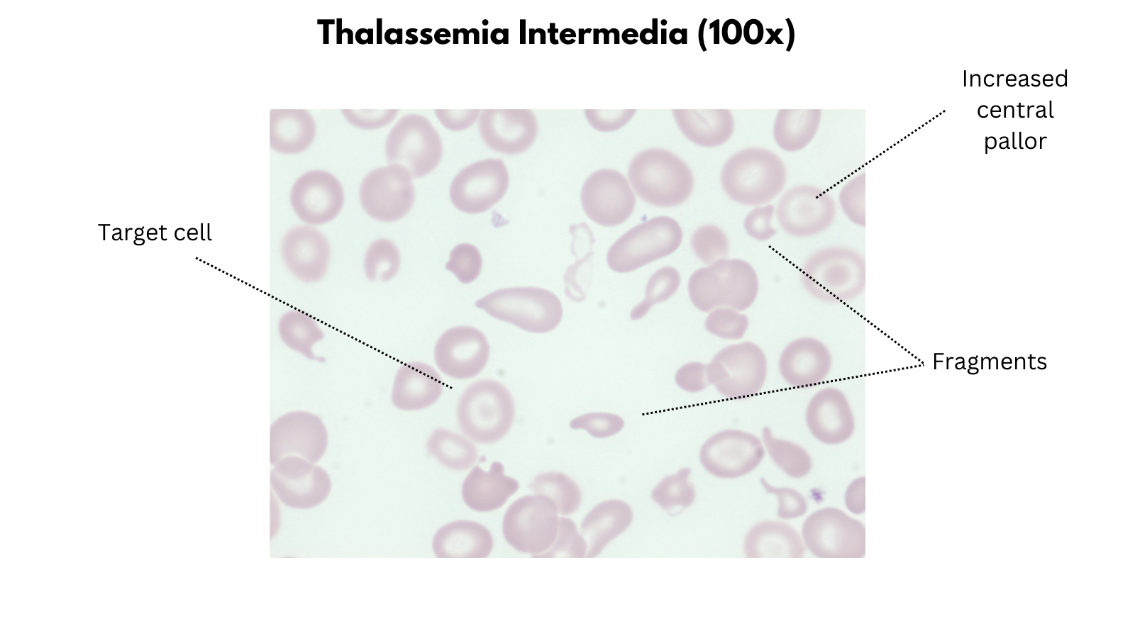 Microcytic Anemias • The Blood Project