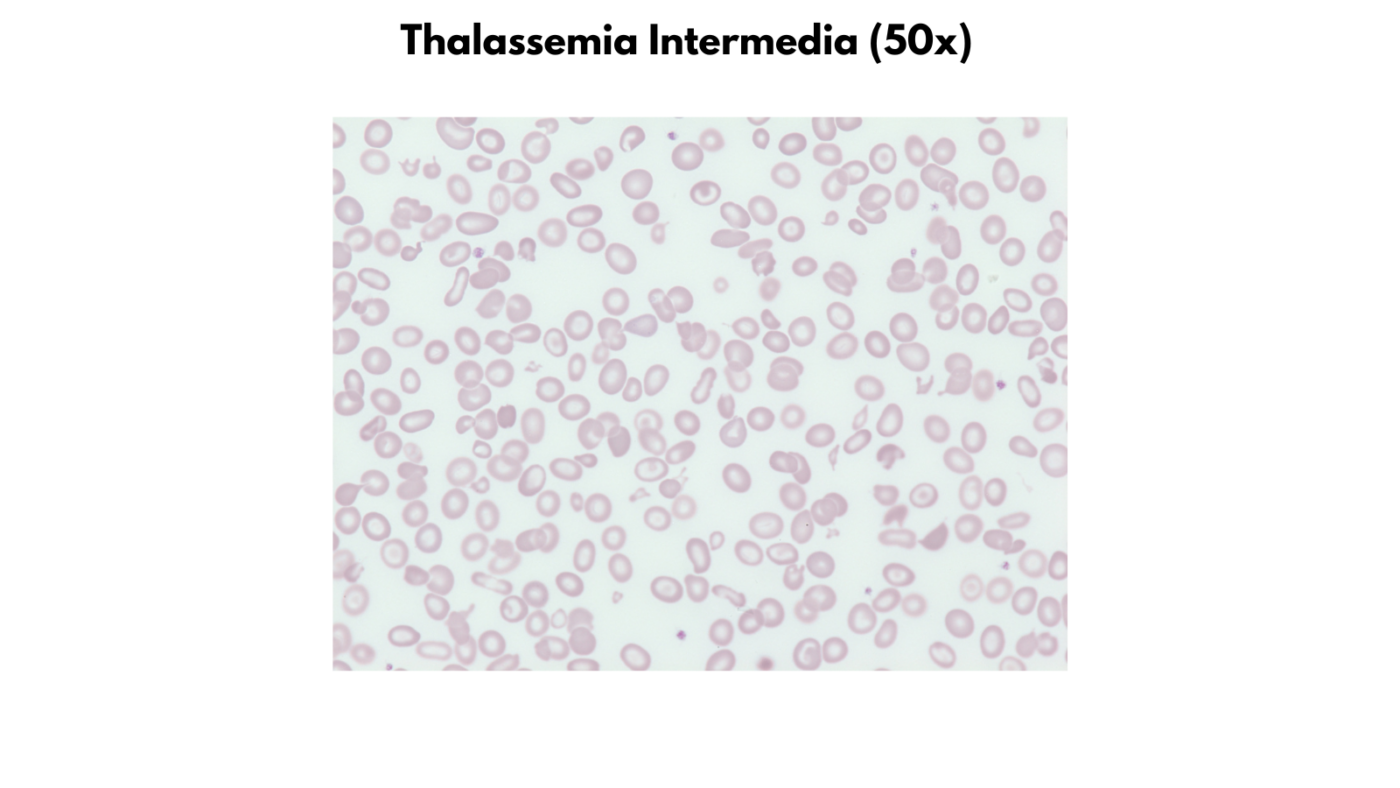 Microcytic Anemias • The Blood Project