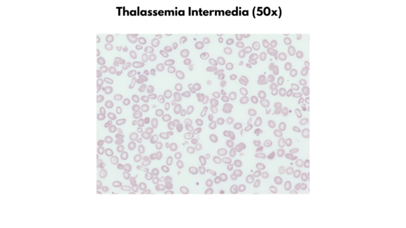 Microcytic Anemias • The Blood Project