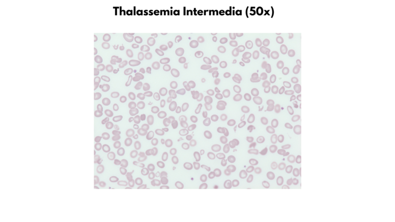 Microcytic Anemias • The Blood Project