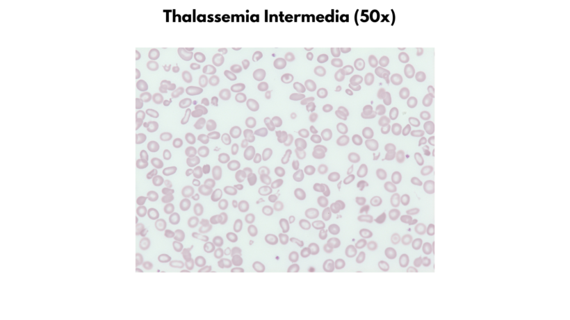 Microcytic Anemias • The Blood Project