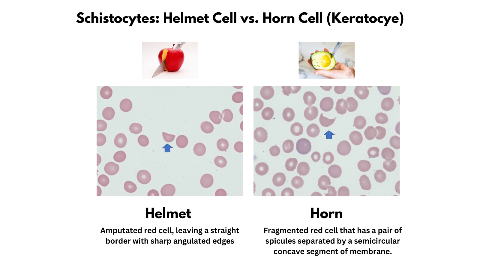 Poikilocytes • The Blood Project